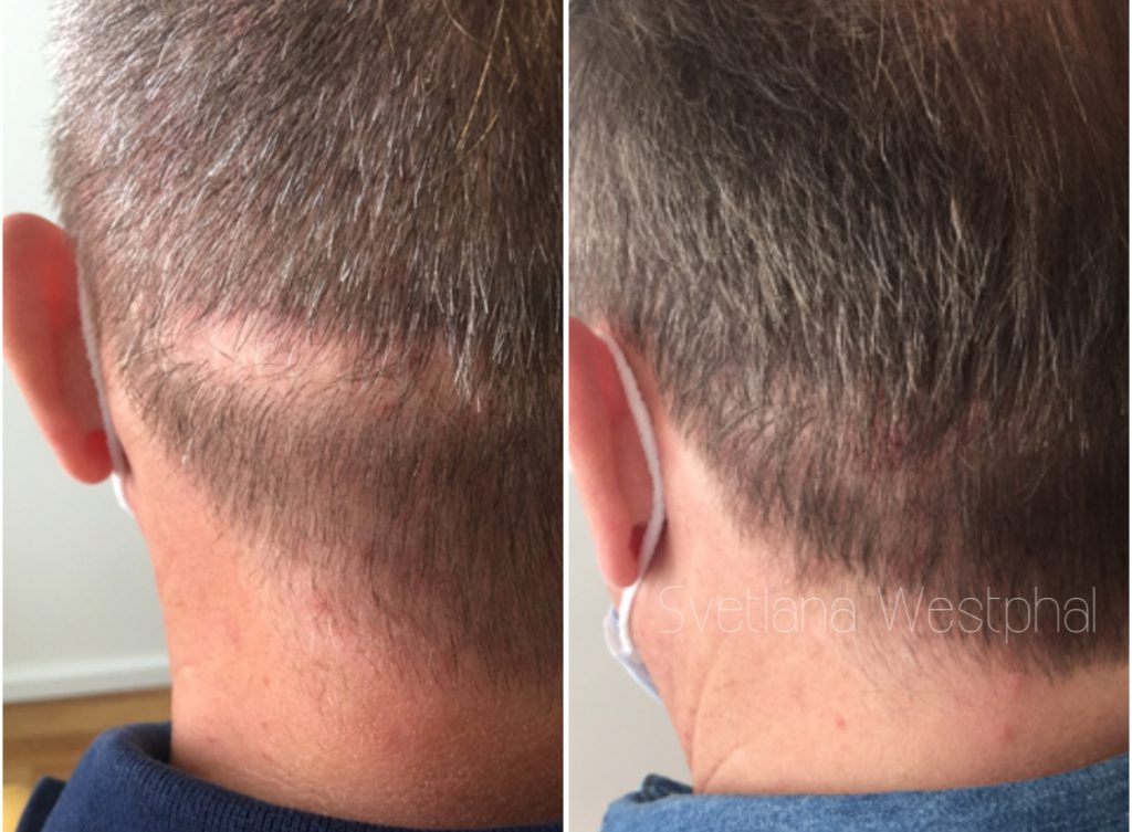 Permanent Make Up für Narbenkorrektur | PMU Berlin